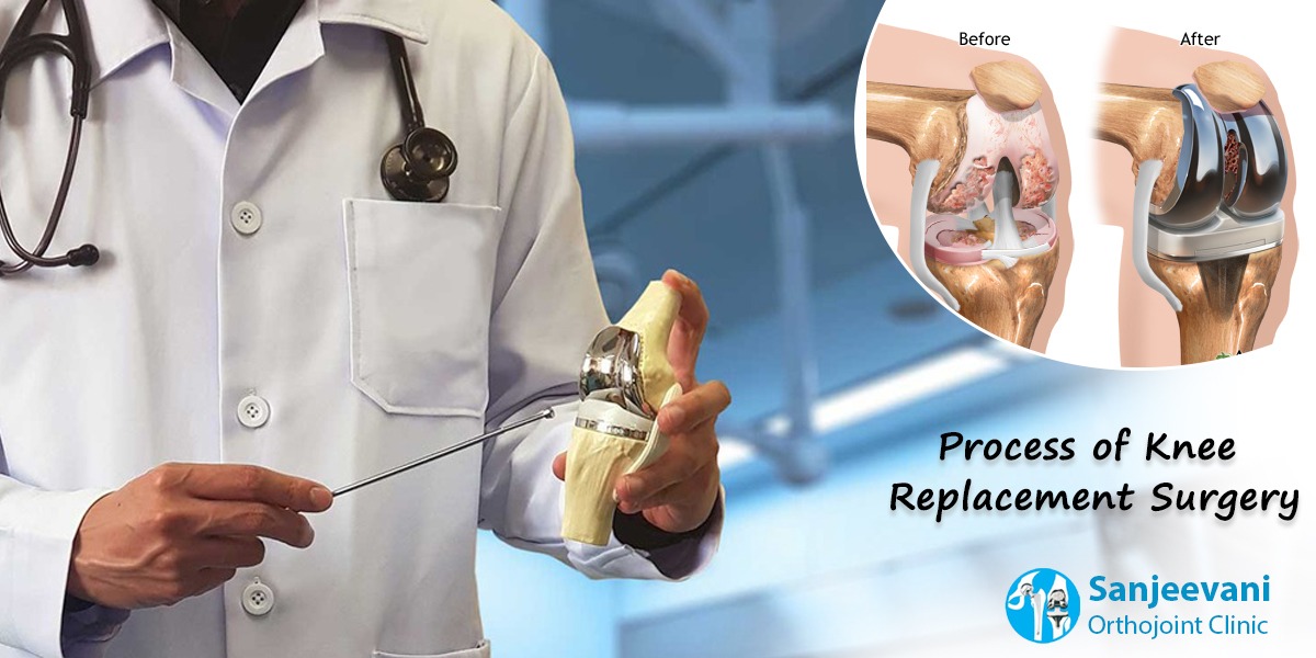 Knee Replacement: 4 Reasons to find the Best Orthopaedic Doctor