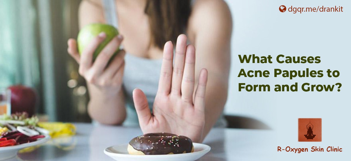 Acne Papules: What Is It And How Can You Get Rid of It?