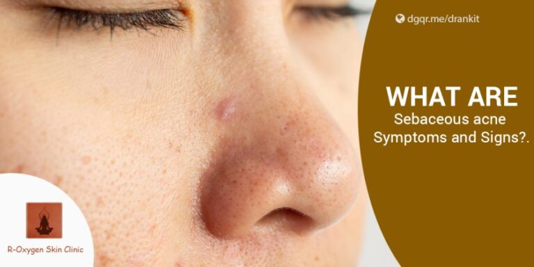 Sebaceous Acne: How to get rid of it effectively | Get rid of Acne